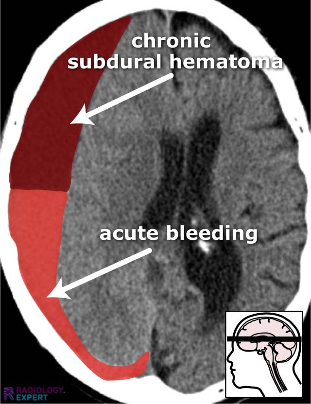 Intracerebral Hemorrhage Ct Novel Imaging Model Of Basal Ganglia ICH